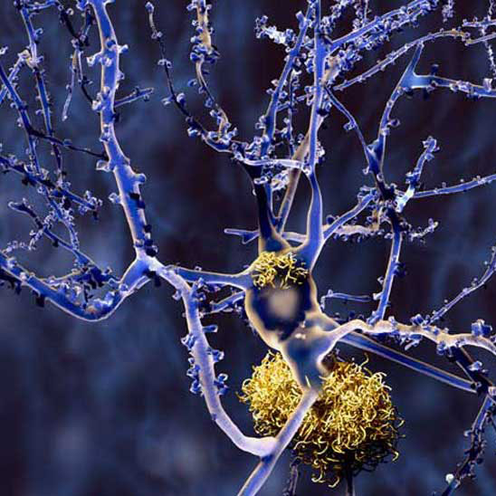 alzheimers_main-1-1 - Teso College Aloet